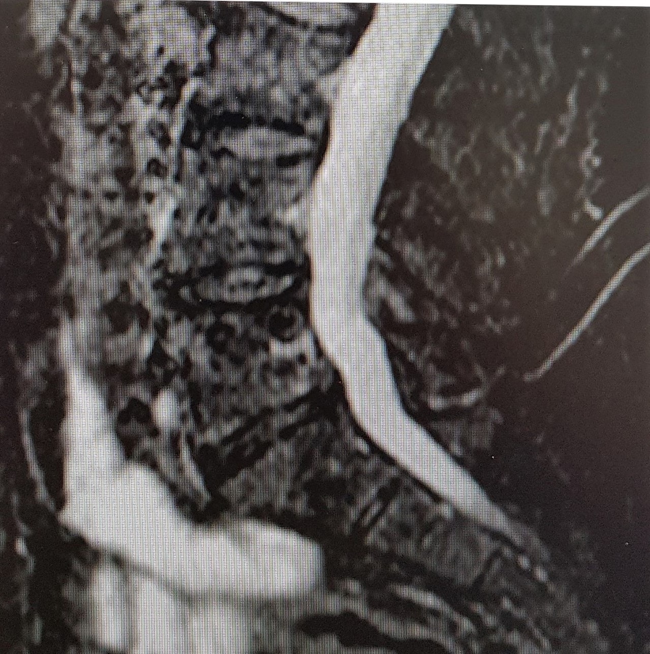What Causes Sciatica and How to Treat It